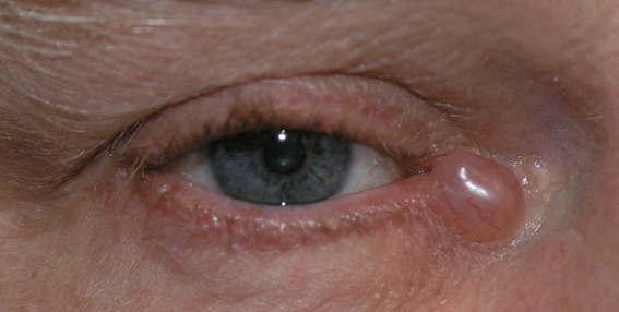 Eyelid Cyst