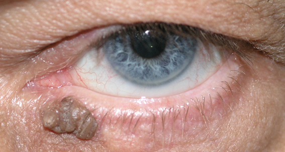 Liverpool Eye Clinic - Eyelid Cysts