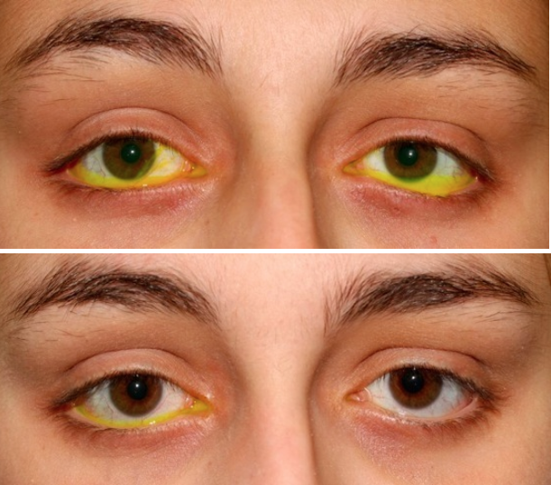 Liverpool Eye Clinic - Lacrimal Surgery