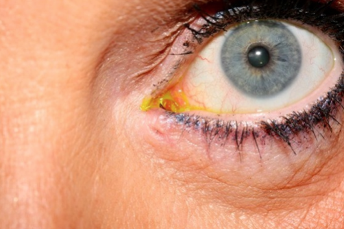 Liverpool Eye Clinic - Lacrimal Surgery